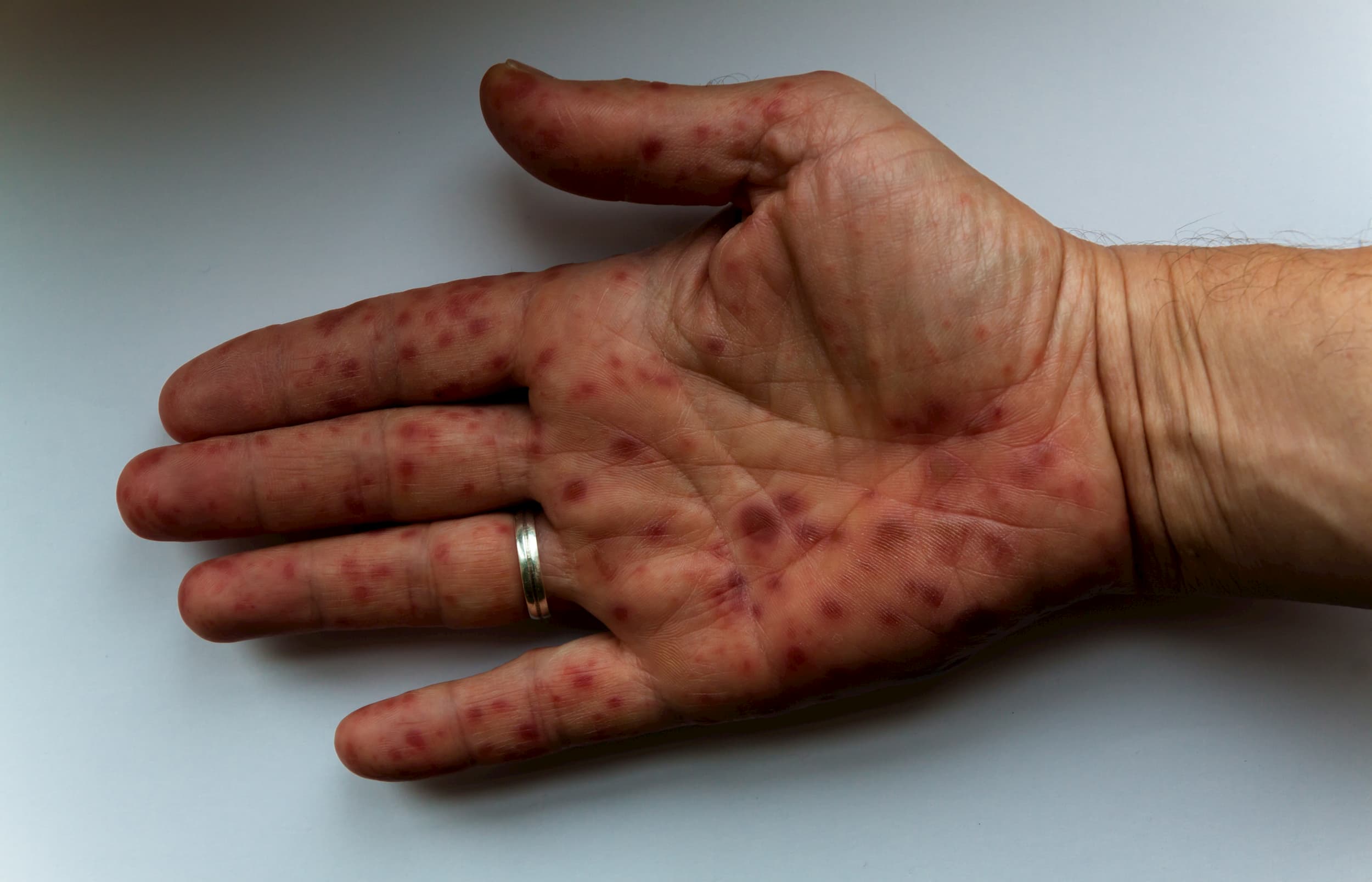 Hand, Foot and Mouth Disease - London ENT Clinic